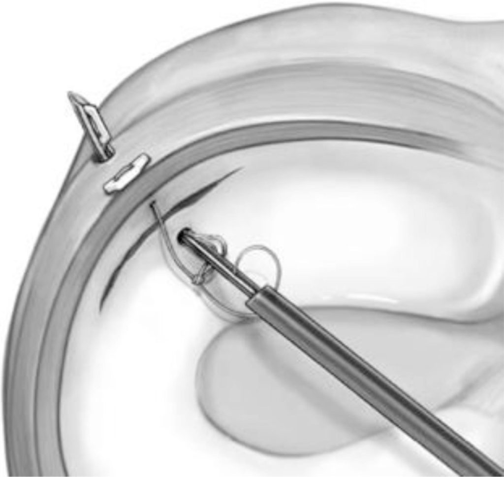 Suture ménsicale Fast-Fix® | Dr Philippe Greiner